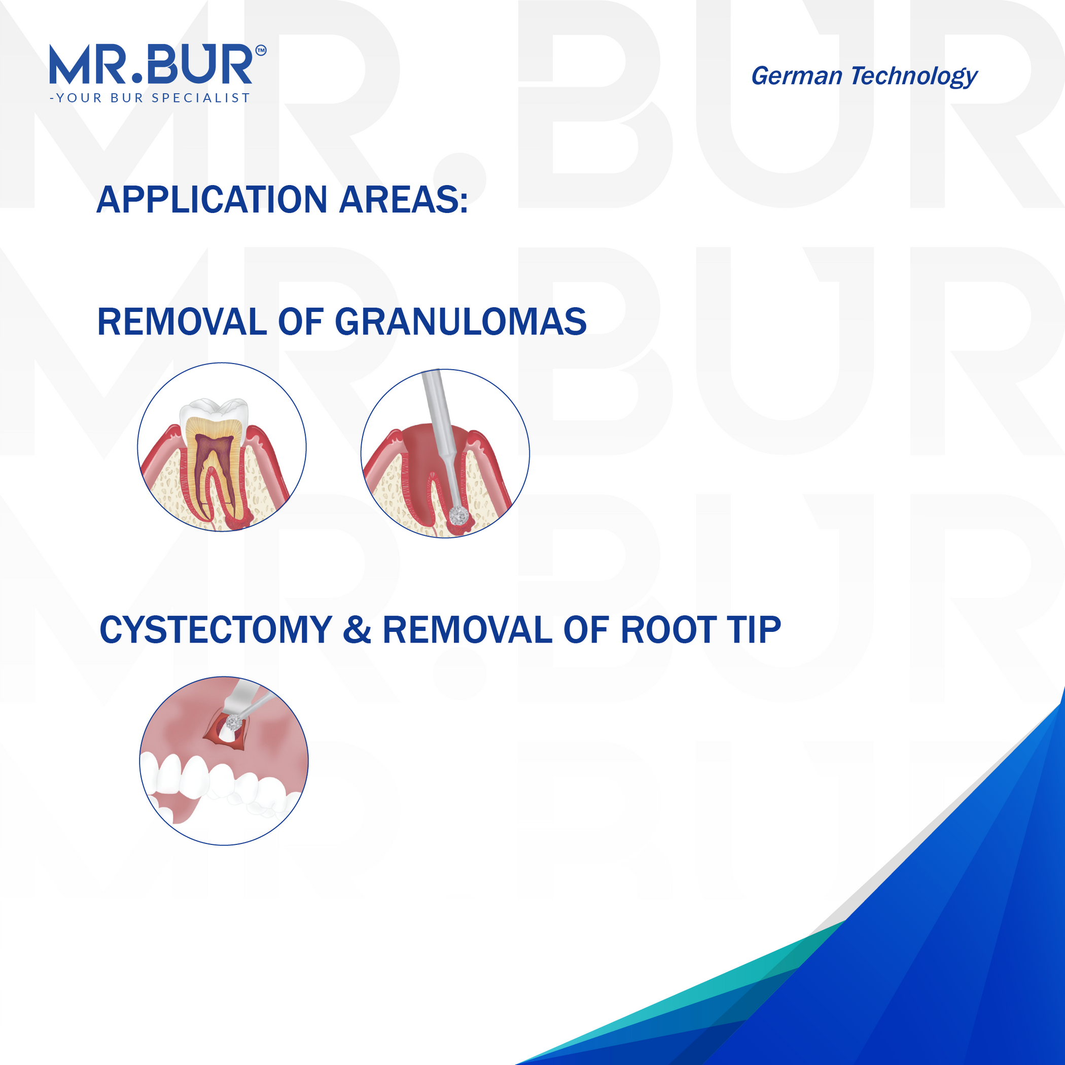 Best Degranulation Kit for Implantology, Endodontic and Periodontal ...
